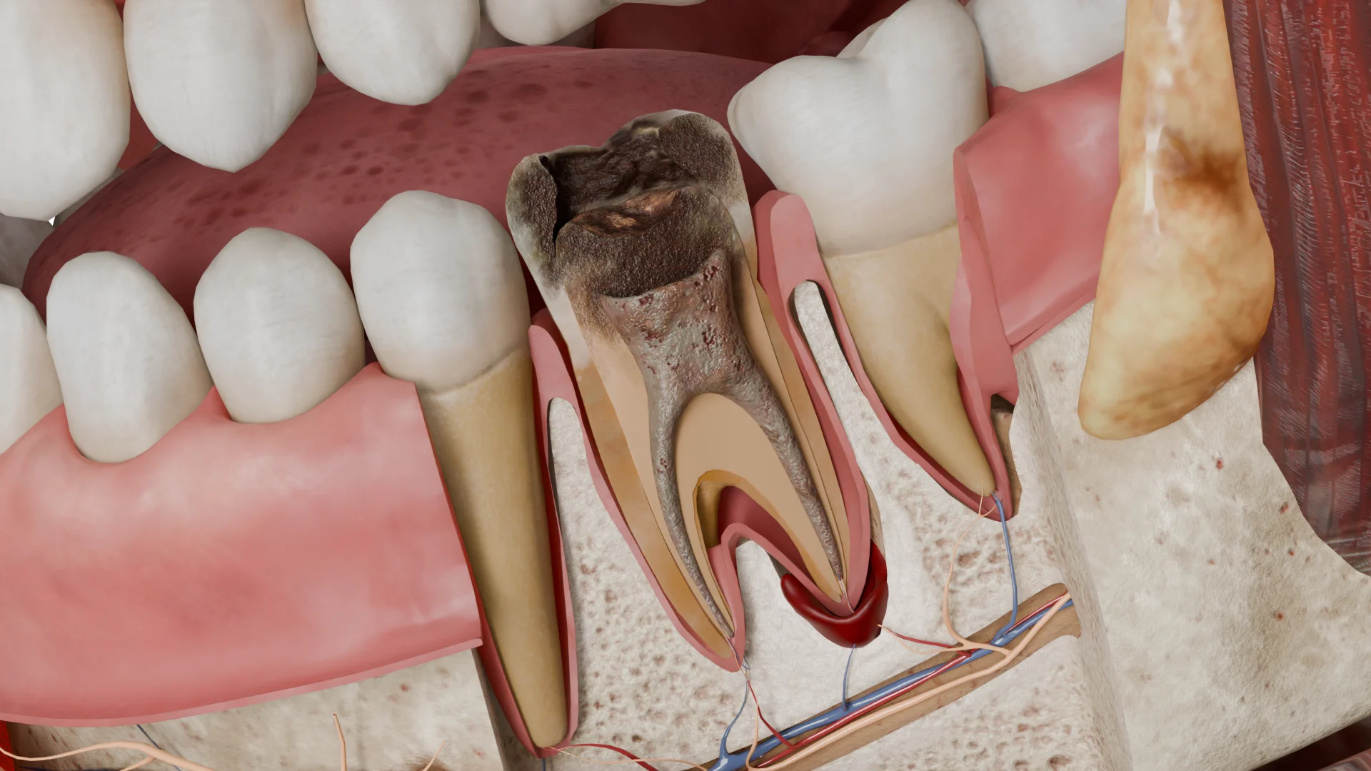 Irreversible Pulpitis: Etiology, Anatomy, Clinical Picture and Treatment
